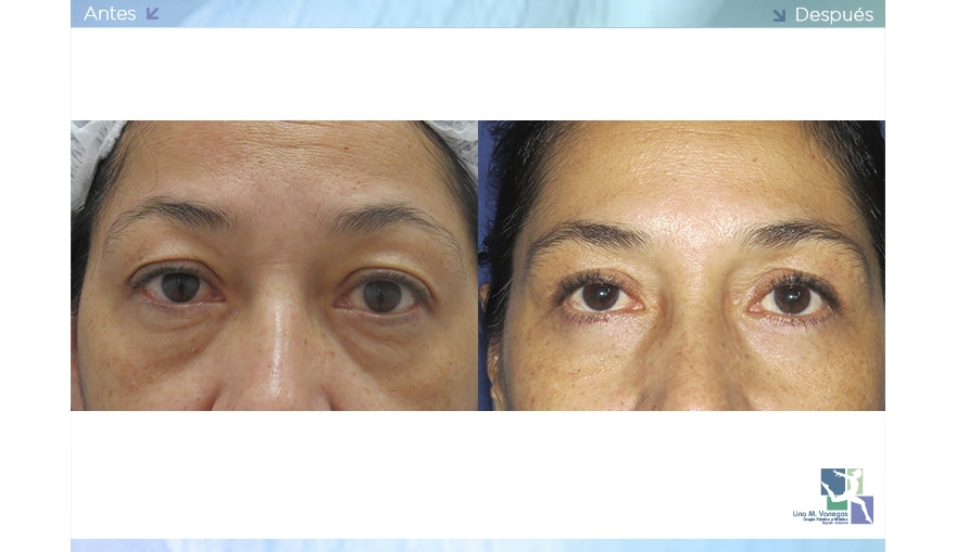Fotos Blefaroplastia – Cirugía de Párpados – Dra. Lina M. Vanegas
